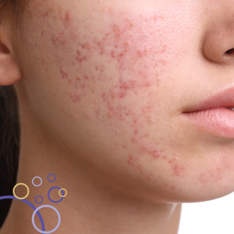 Dermatology – Acne – Red Flags and Differential Diagnosis – UK – Morph ...